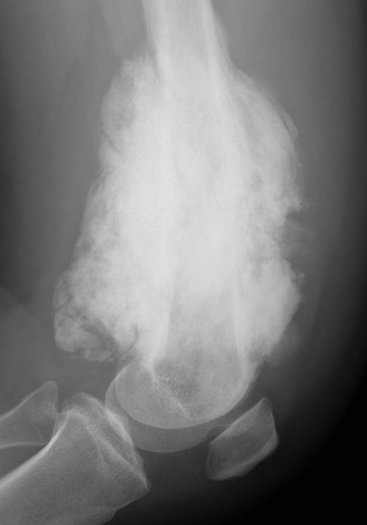 Conventional Osteosarcoma | The Bone School